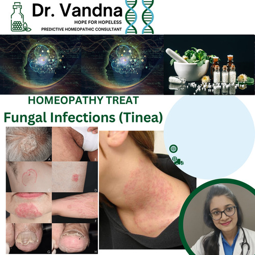 Online Skin Fungal Infections Homeopathy Treatment at Best Price in ...