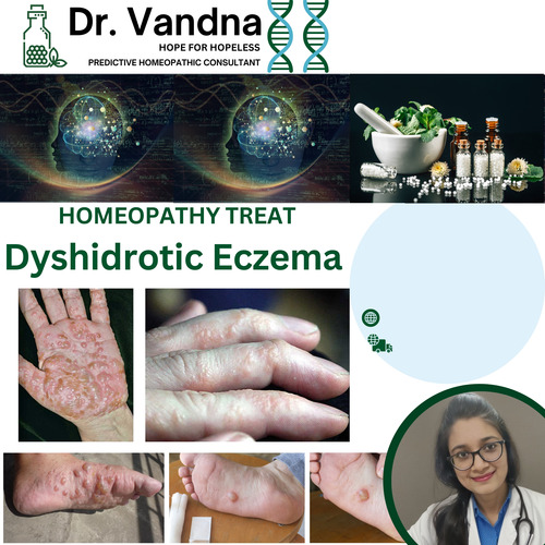 Online Skin Dyshidrotic Eczema Homeopathy Treatment at 5000.00 INR in ...